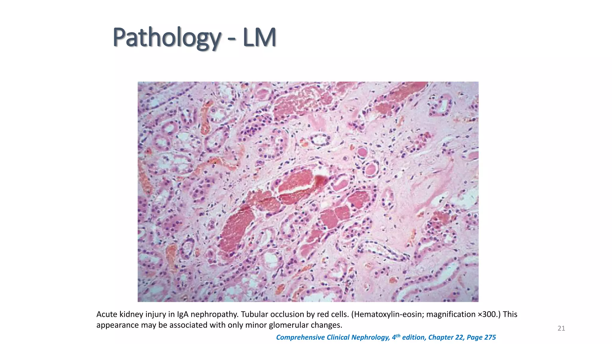 IgA Nephropathy (KDIGO 2021 Guidelines) - Dr. Gawad | PPTX
