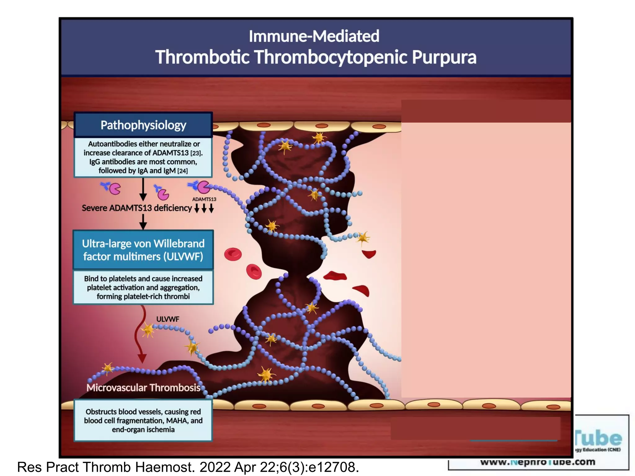 Thrombotic Microangiopathy (TMA) in Adults and Acute Kidney Injury - Dr ...
