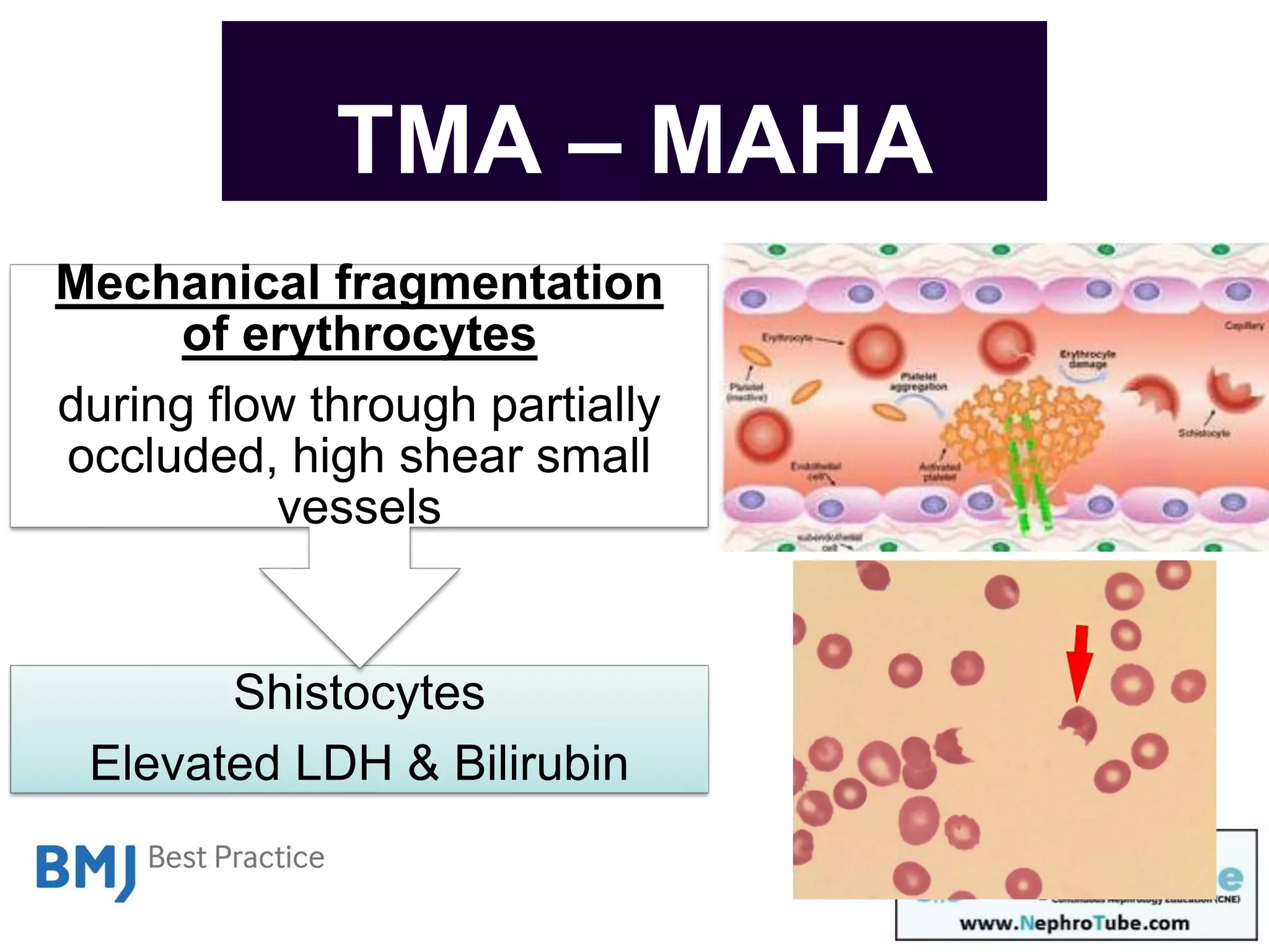 Thrombotic Microangiopathy (TMA) in Adults and Acute Kidney Injury - Dr ...