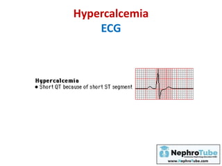 Hypercalcemia (Practical Approach) - Dr. Gawad | PDF