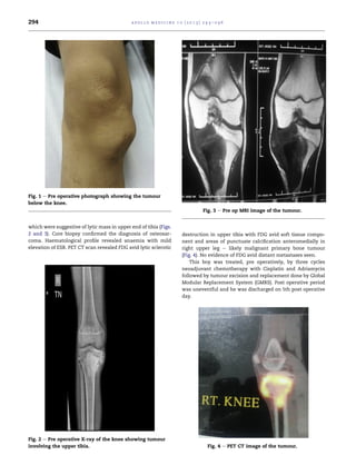 Megaprosthetic replacement of knee in a young boy of 14 years | PDF