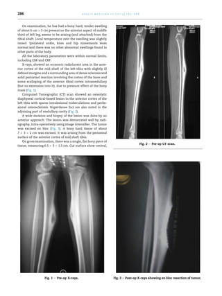 Giant osteoid osteoma of tibial shaft: A rare case report | PDF