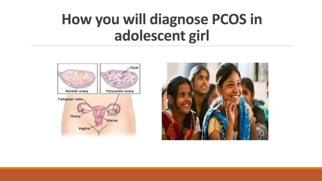 Presentation on Diagnosis of Polycystic Ovary Syndrome (PCOS) | PDF