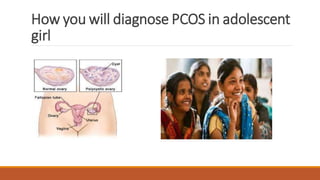 Presentation on The Diagnosis of Polycystic Ovary Syndrome (PCOS) | PDF