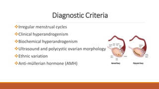 Presentation on The Diagnosis of Polycystic Ovary Syndrome (PCOS) | PDF