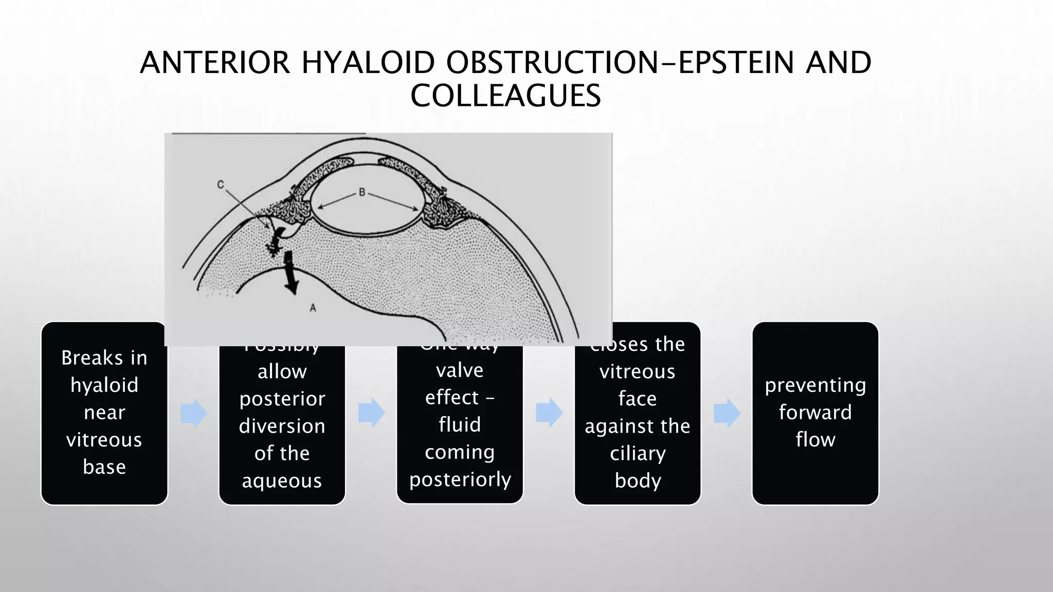 Mailgnant glaucoma simplified | PPTX