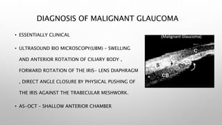 Mailgnant glaucoma simplified | PPT