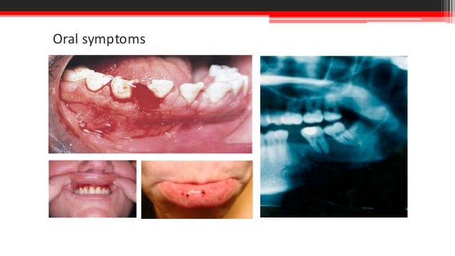 Haemophilias: Medically Compromised Children in Dentistry