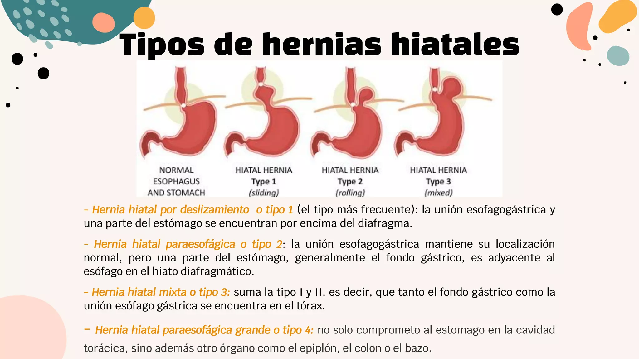 Hernia hiatal.pdf