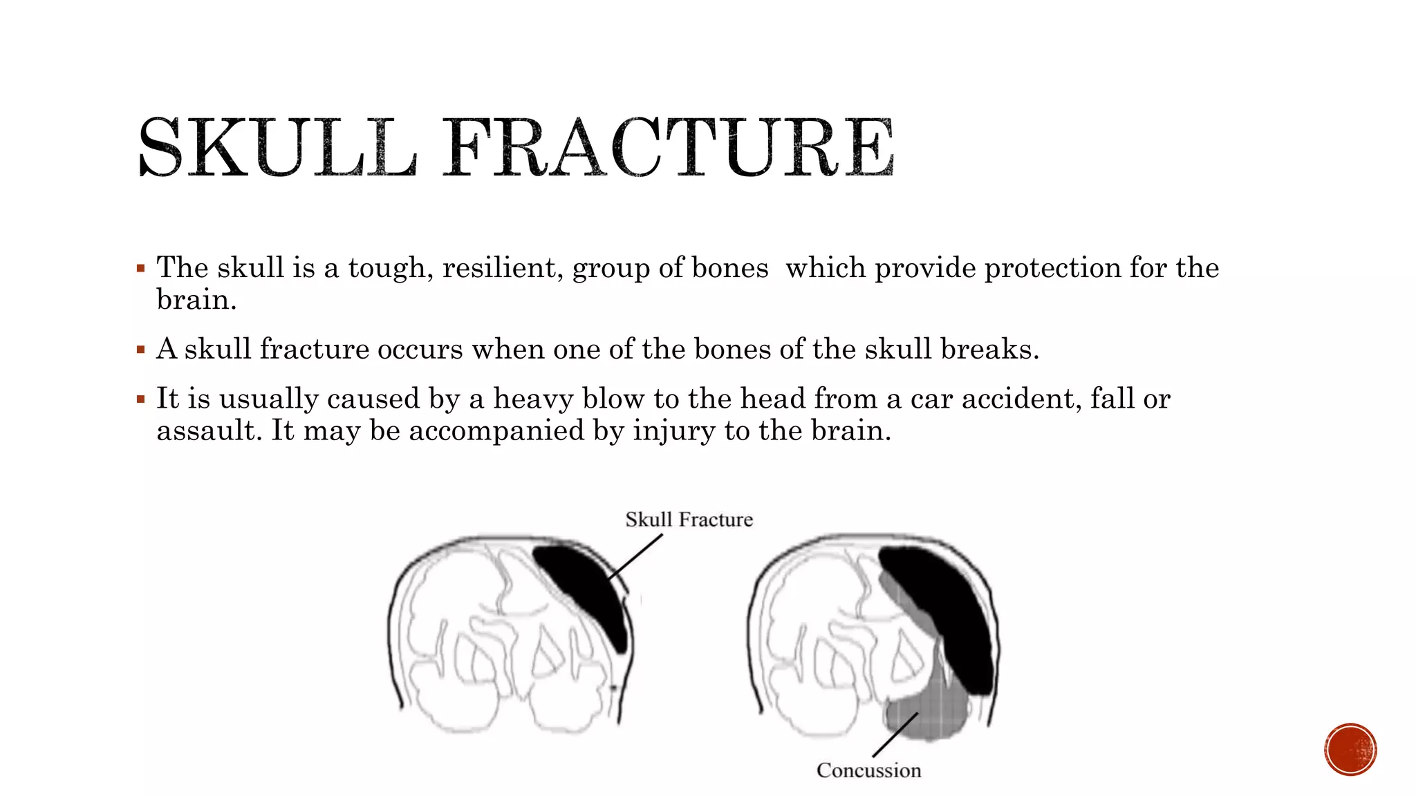 SKULL FRACTURES | PPTX