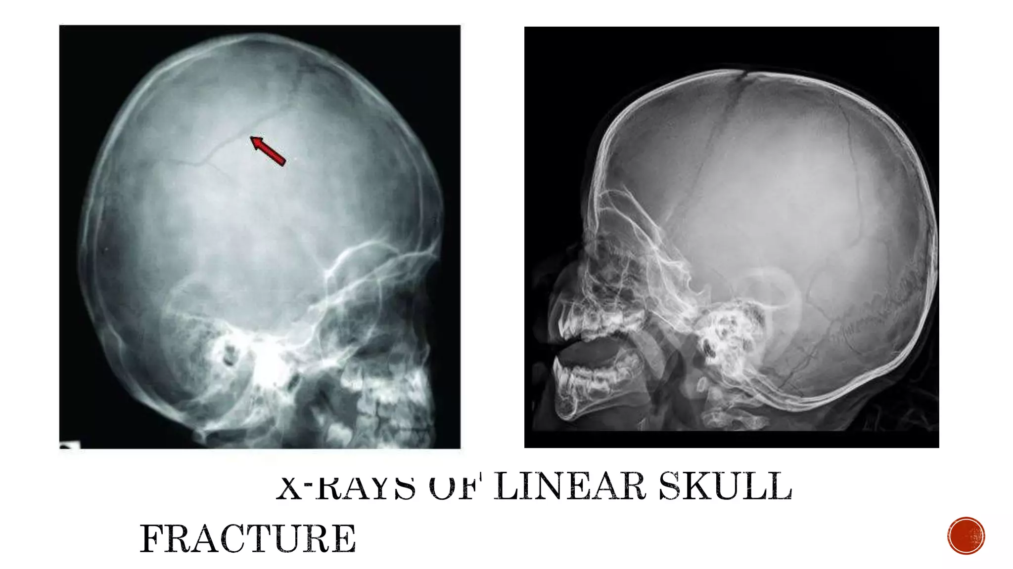 SKULL FRACTURES | PPTX