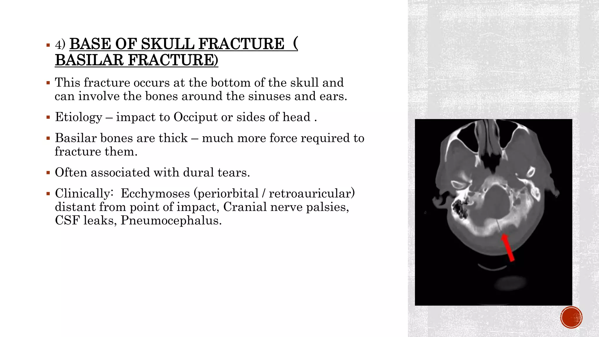 SKULL FRACTURES | PPTX