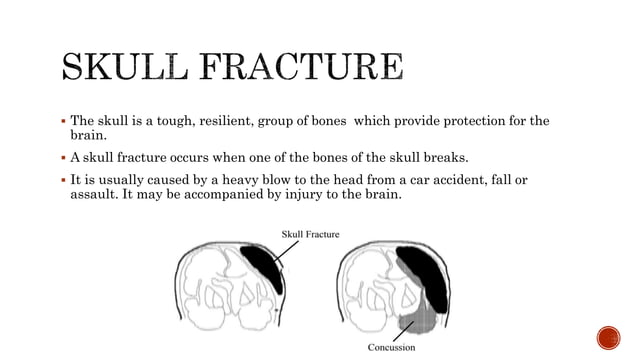 SKULL FRACTURES | PPTX