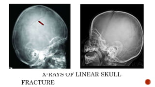 Linear Skull Fracture
