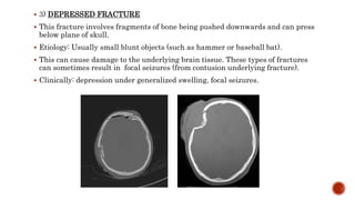Depressed Fracture