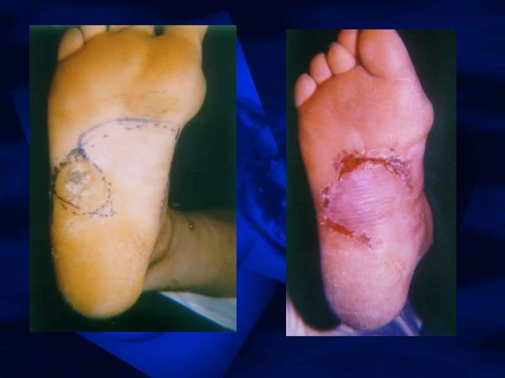PLASTIC SURGERY OF THE DIABETIC FOOT | PPT