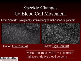 Introduction of Laser Speckle Flowgraphy LSFG-PFI | PDF