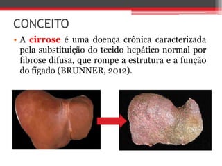 CIRROSE HEPÁTICA | PPTX