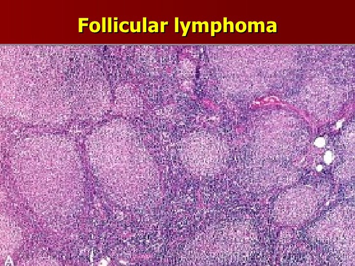 Lymphoma Slide