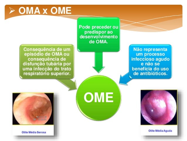 Otite Média Aguda (OMA) / Acutes Otites Media