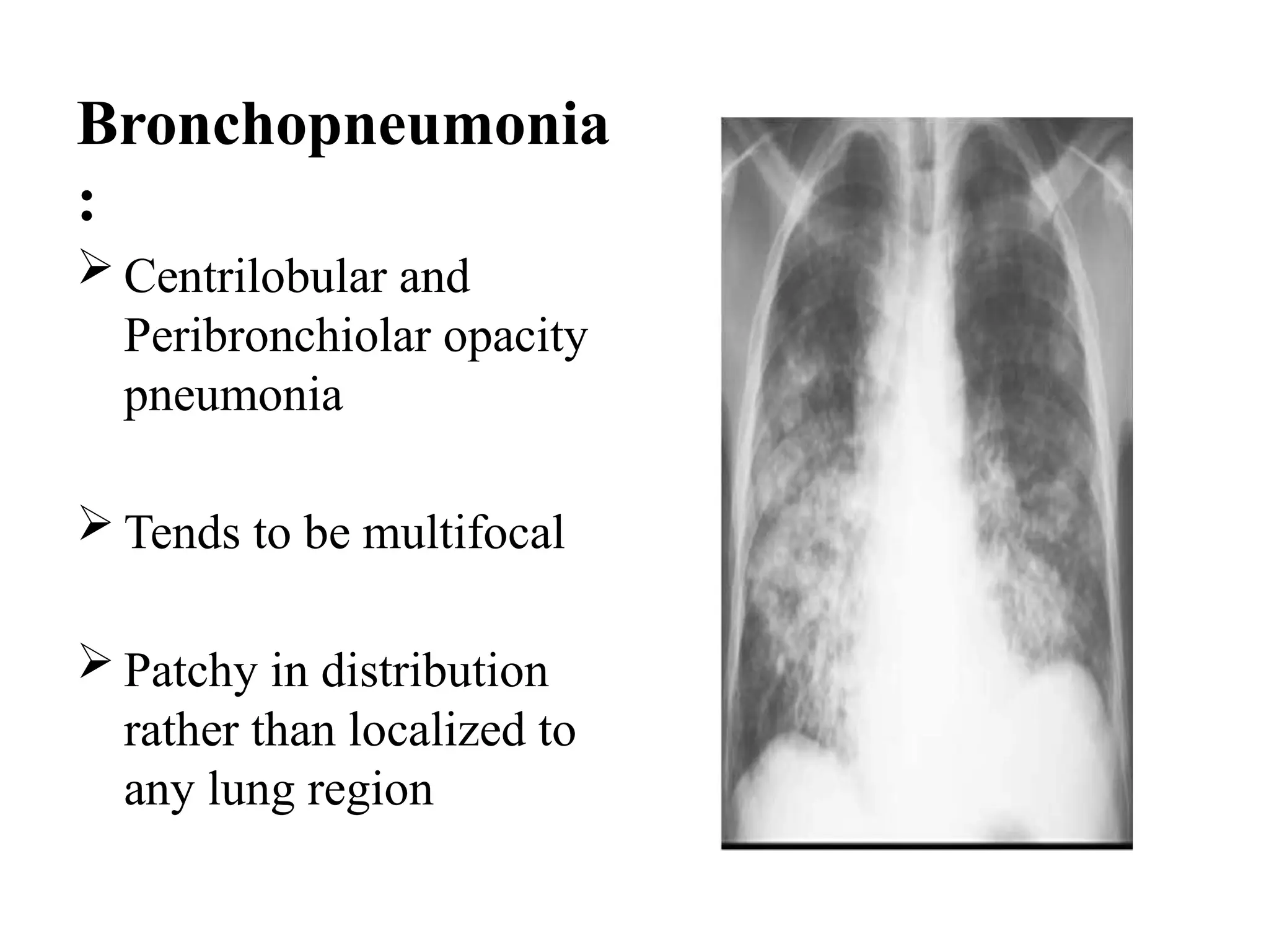 SLIDES PNEUMONIA.pptx by Simon peter kayiwa | PPTX