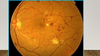 Ophthalmology Slides revision | PPTX | Eye and Vision Conditions ...