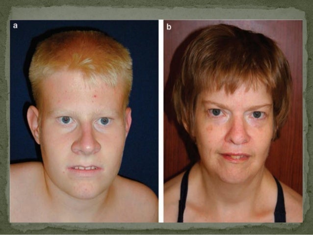 Síndromes de Prader-Willi e Angelman