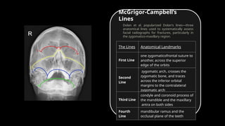 clinical use of waters projection in determining sinus problems | PPTX