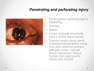 Slide trauma oculus | PPTX