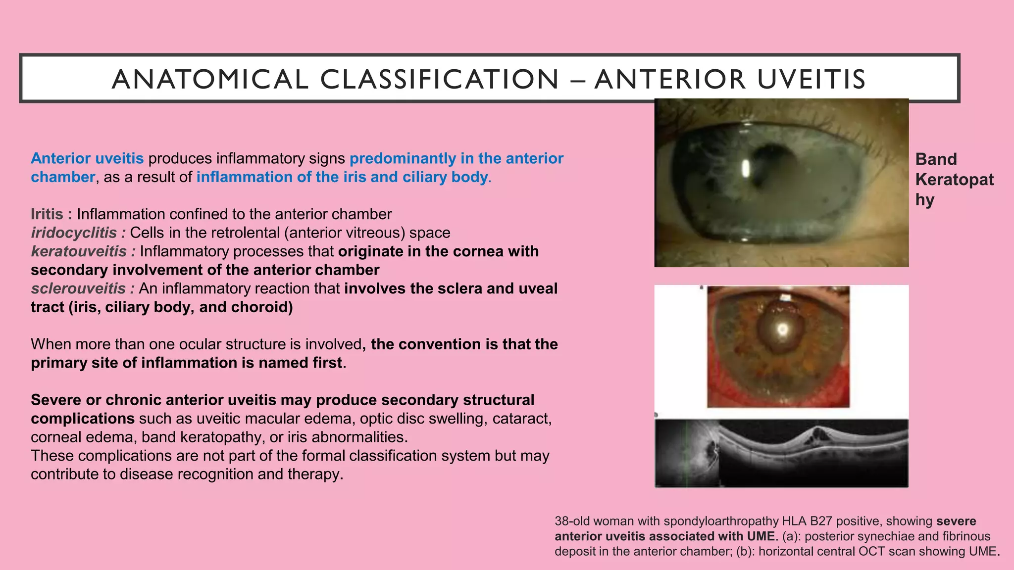 Slide Uveitis Anterior To Posterior Pptx Eye And Vision Conditions Diseases And Conditions