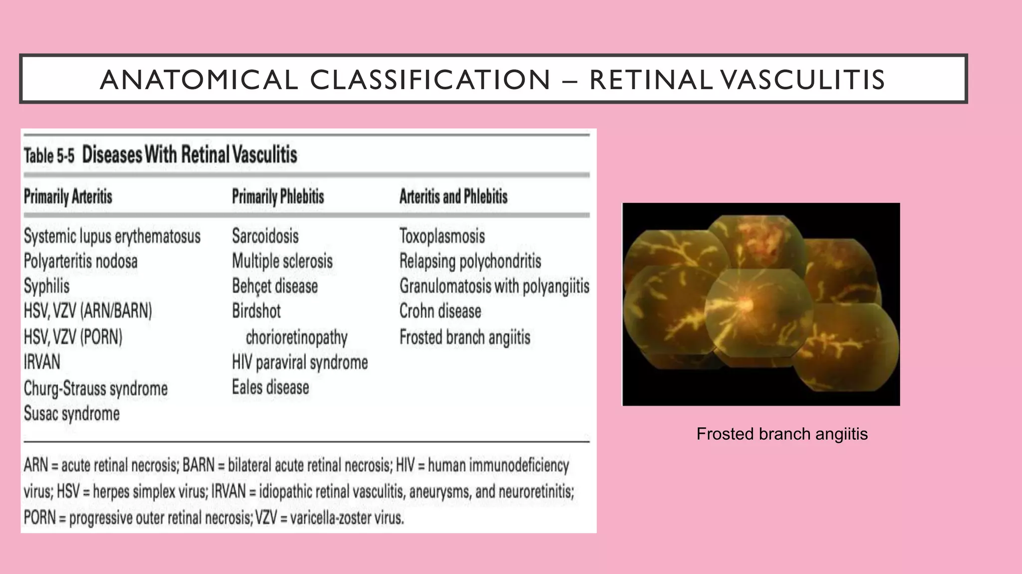 SLIDE UVEITIS ANTERIOR TO POSTERIOR .pptx | Eye and Vision Conditions ...