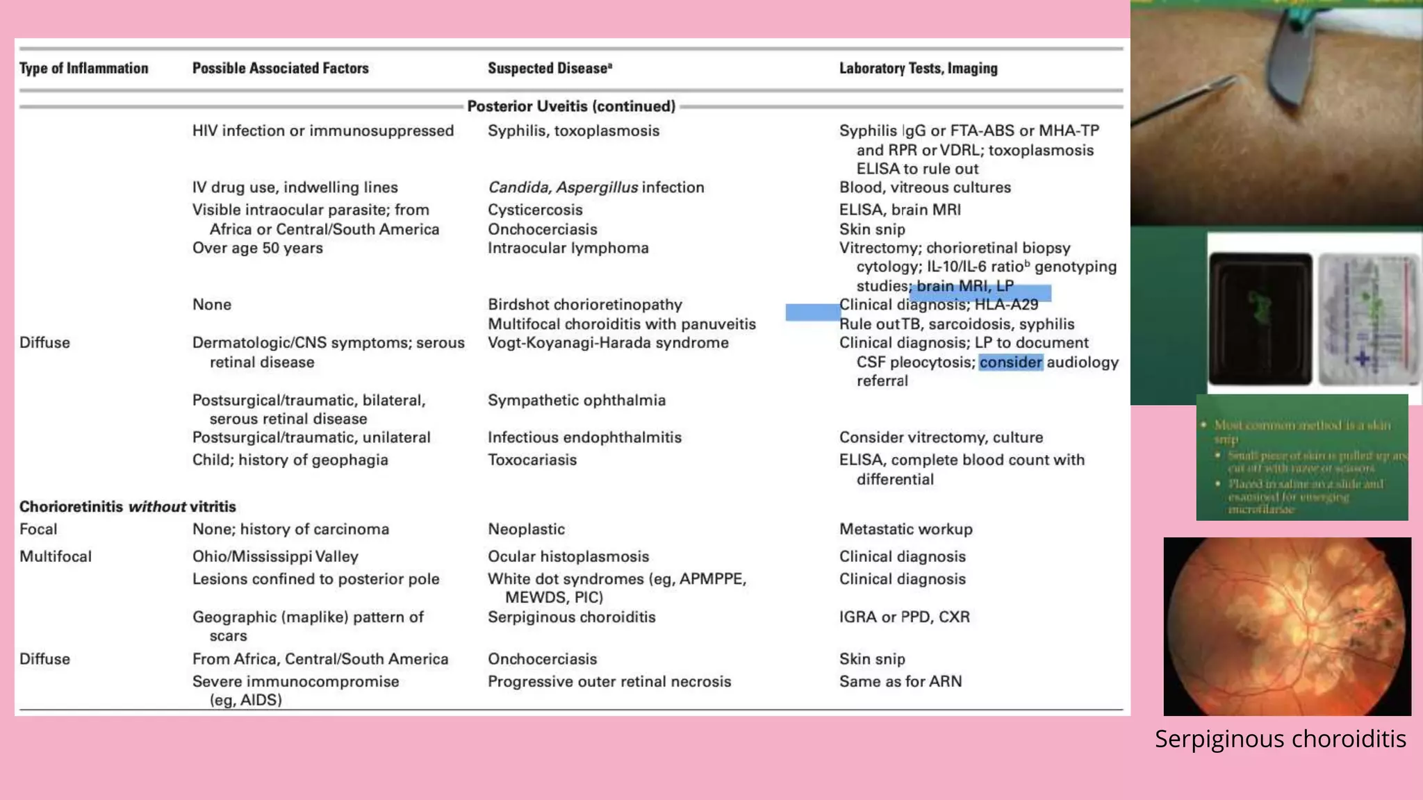 Slide Uveitis Anterior To Posterior Pptx