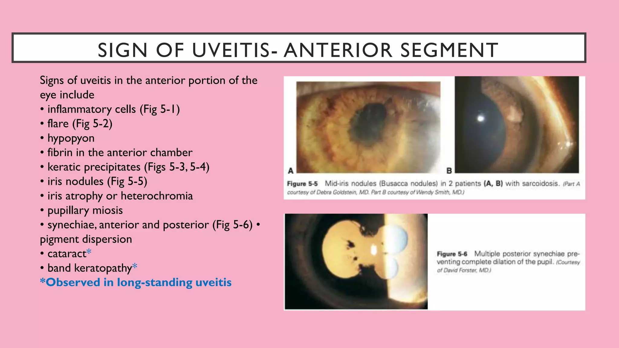 SLIDE UVEITIS ANTERIOR TO POSTERIOR .pptx
