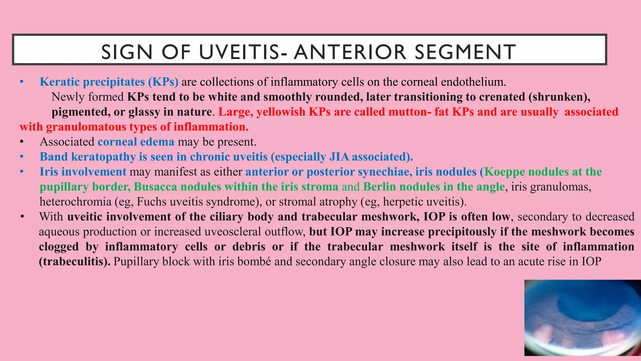SLIDE UVEITIS ANTERIOR TO POSTERIOR .pptx