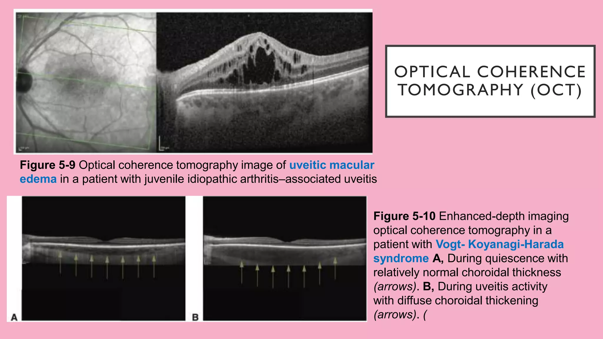SLIDE UVEITIS ANTERIOR TO POSTERIOR .pptx