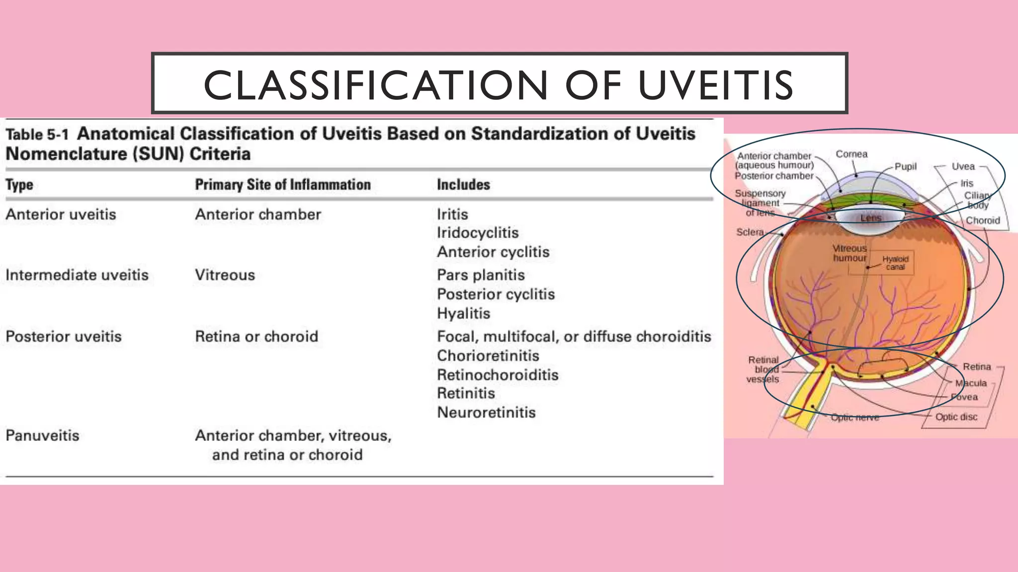 SLIDE UVEITIS ANTERIOR TO POSTERIOR .pptx | Eye and Vision Conditions | Diseases and Conditions