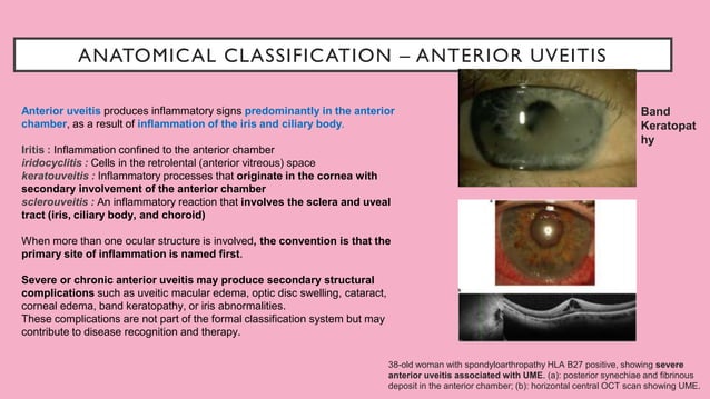 SLIDE UVEITIS ANTERIOR TO POSTERIOR .pptx