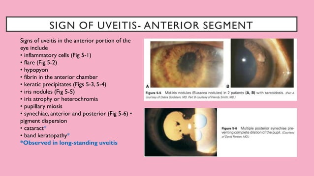 SLIDE UVEITIS ANTERIOR TO POSTERIOR .pptx