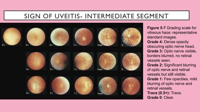 SLIDE UVEITIS ANTERIOR TO POSTERIOR .pptx