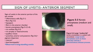 SLIDE UVEITIS ANTERIOR TO POSTERIOR .pptx