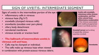 SLIDE UVEITIS ANTERIOR TO POSTERIOR .pptx