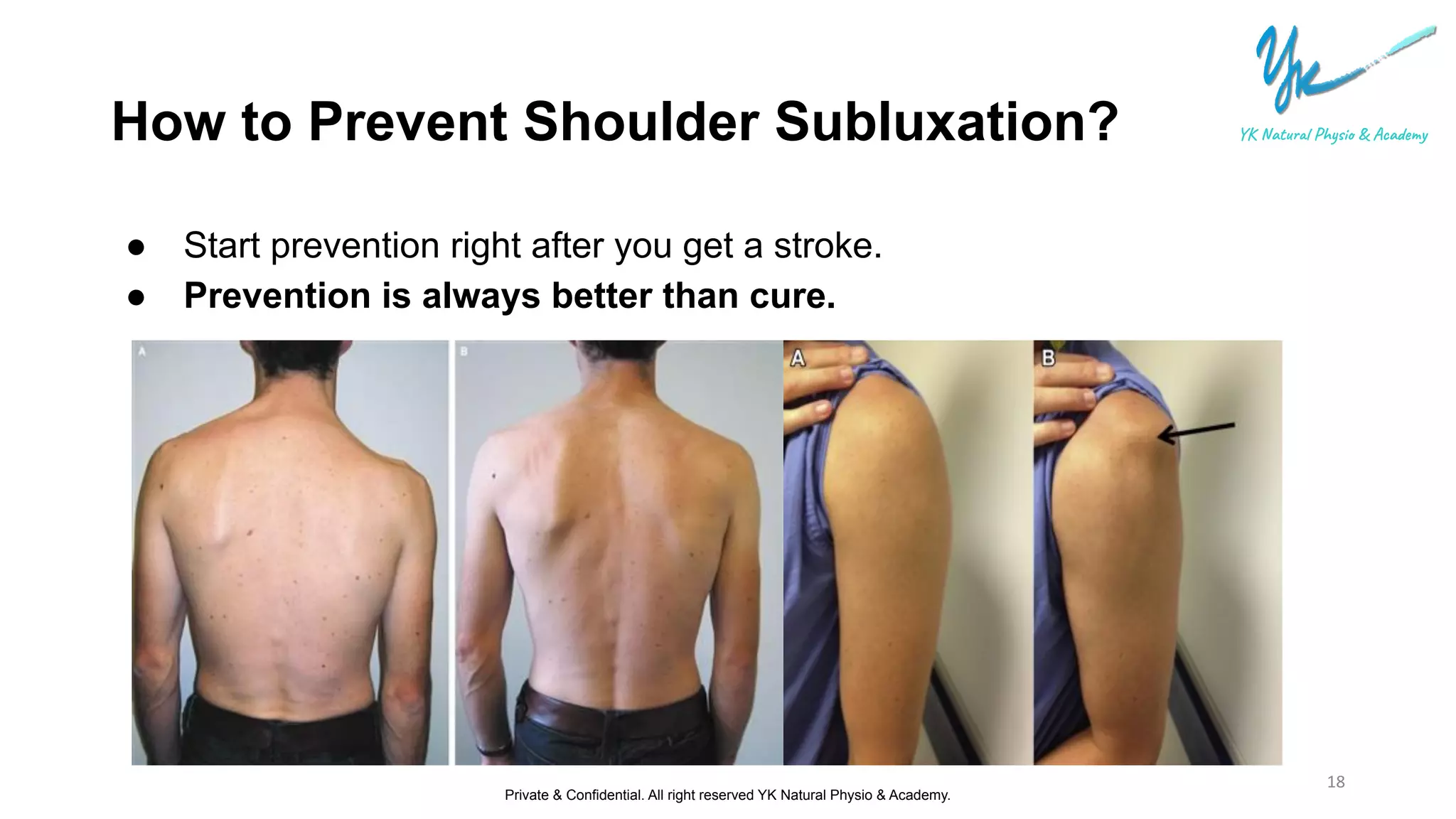 How to Prevent and Treat Shoulder Subluxation After Stroke? | PDF