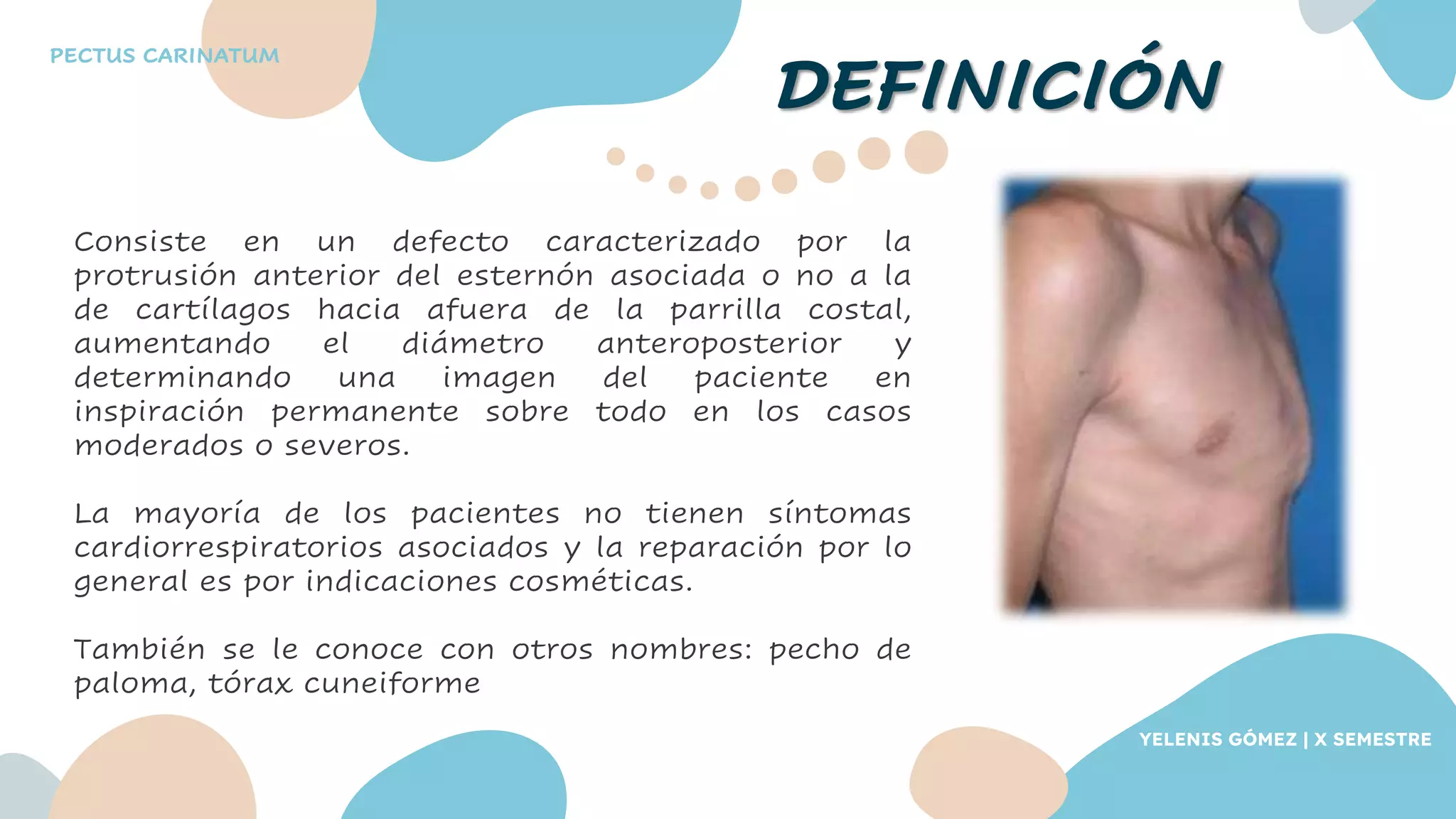 Pectus carinatum- Yelenis Gómez | PPT