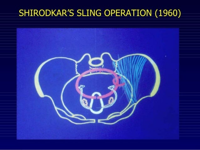Uterus Preserving Surgeries For Prolapse