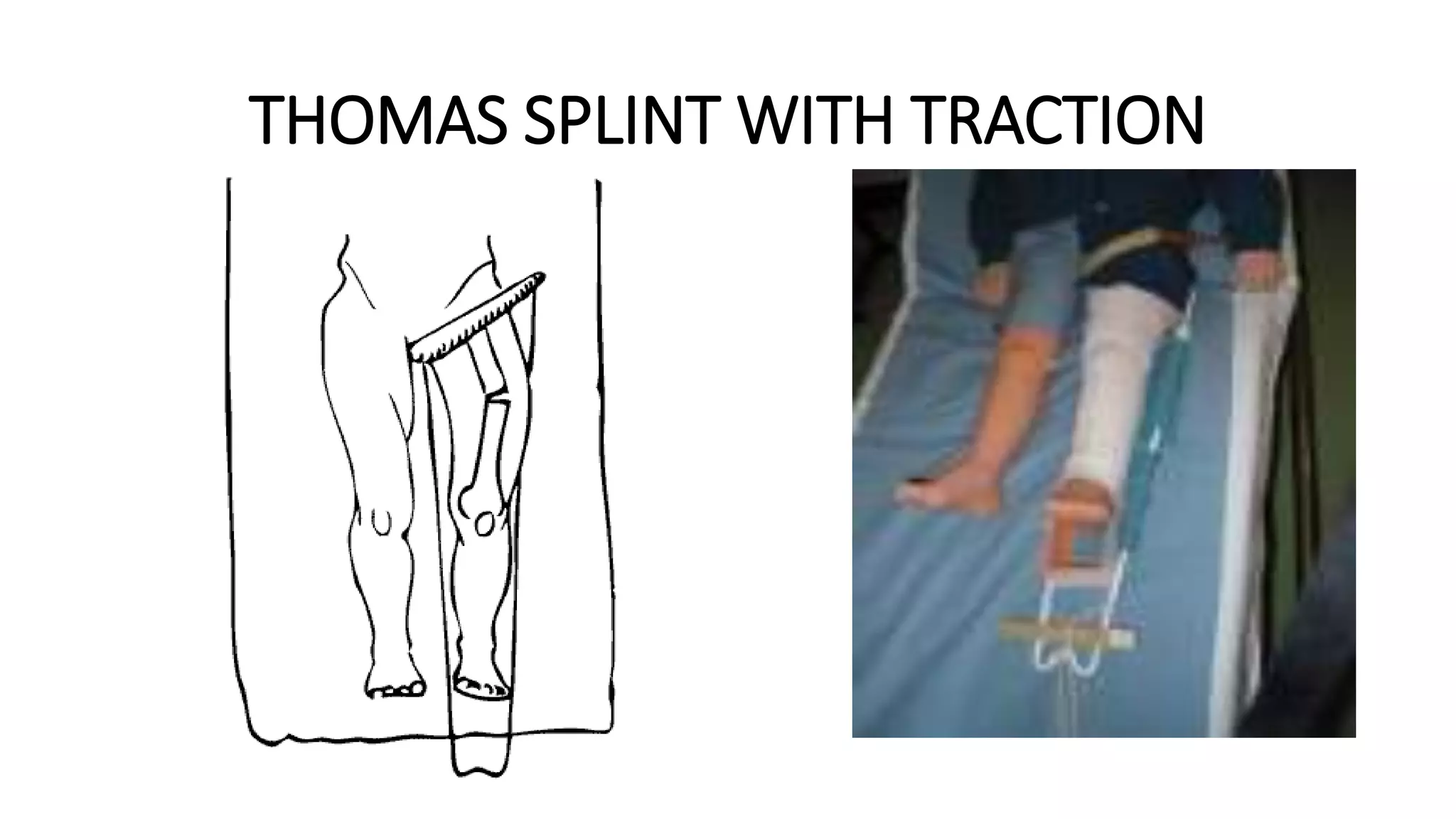 Splints and Tractions | PPTX