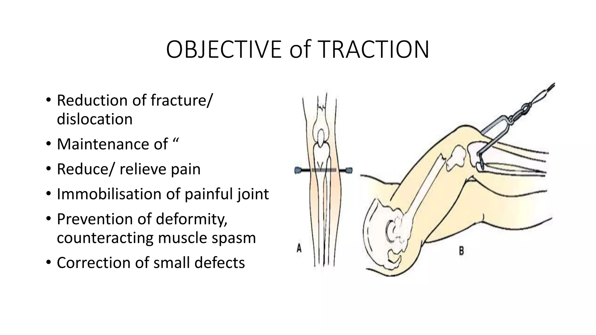 Splints and Tractions | PPTX
