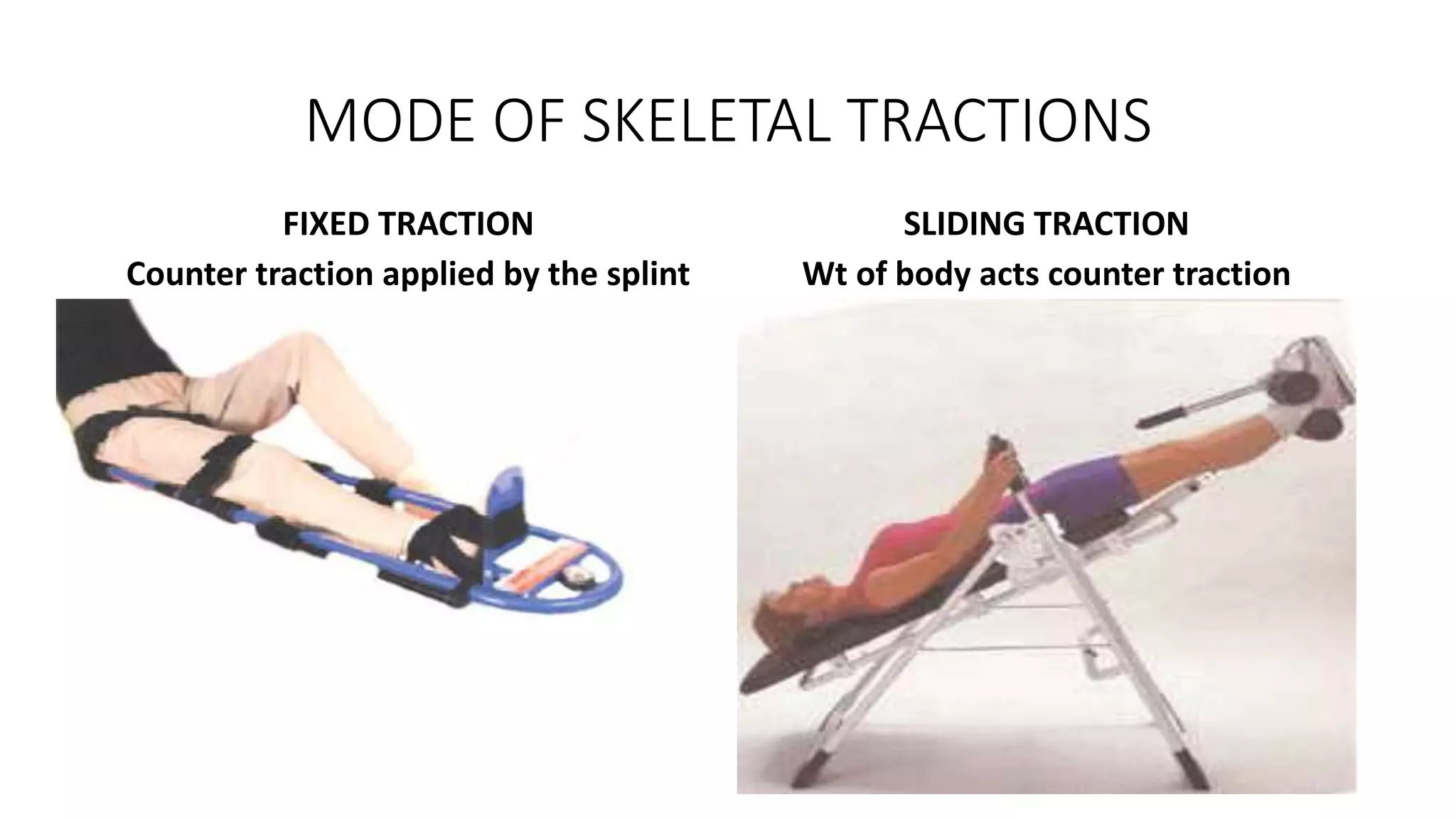 Splints and Tractions | PPTX