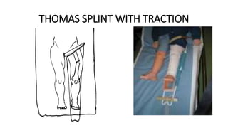 Splints and Tractions | PPTX