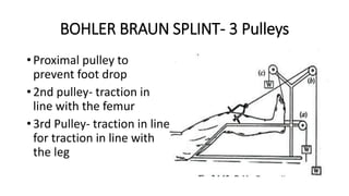 Splints and Tractions | PPTX