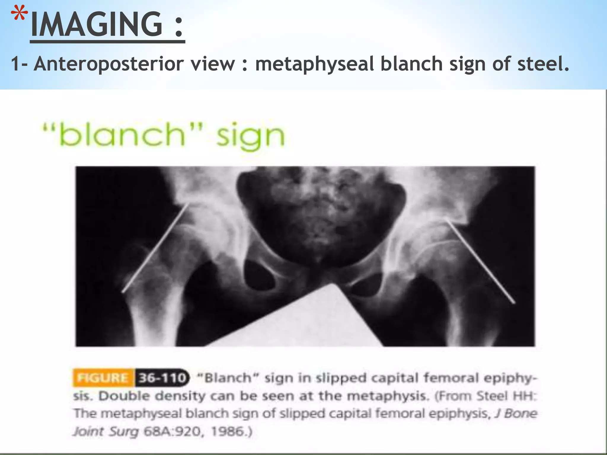 Slipped caital femroal epiphysis (scfe) | PPTX